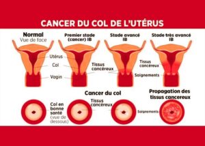 Cancer du col de l’utérus : Symptômes, causes, conséquences ...